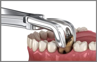 Painless Extraction - Savitri Multi-Speciality Dental Care